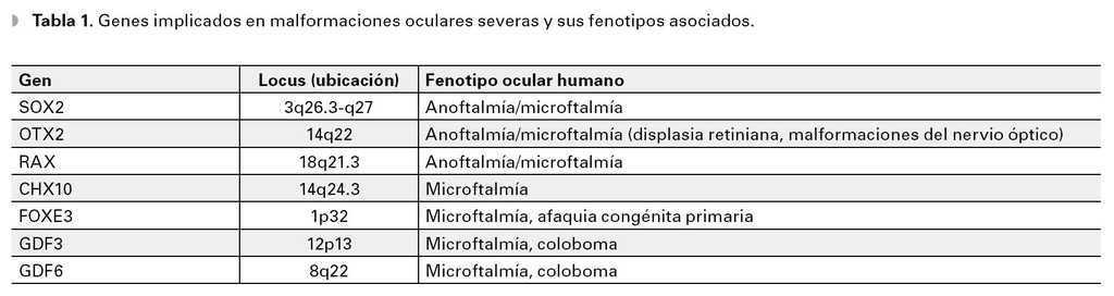 Anoftalmía y microftalmía