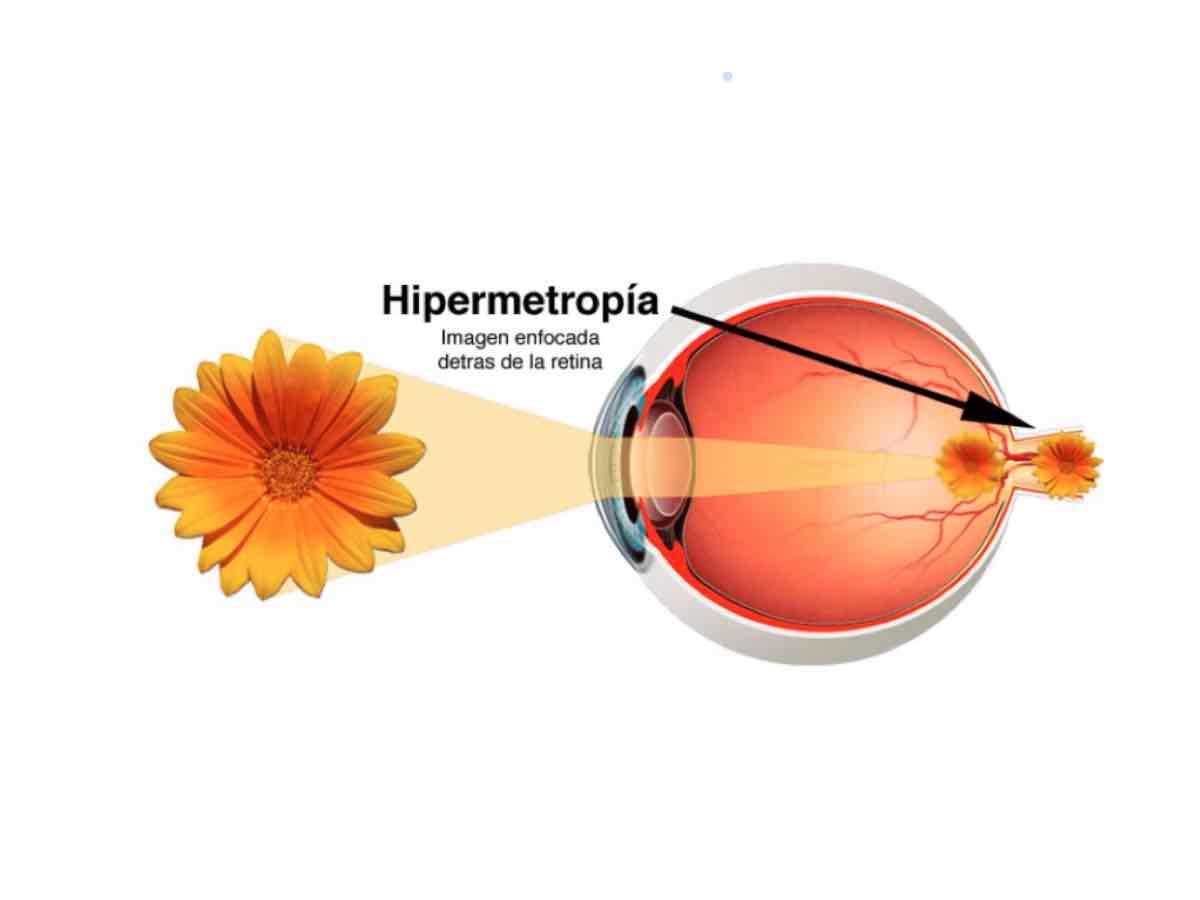 Hipermetropía - En Ojopedia