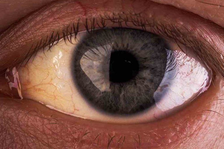 Limbo esclerocorneal - En Ojopedia