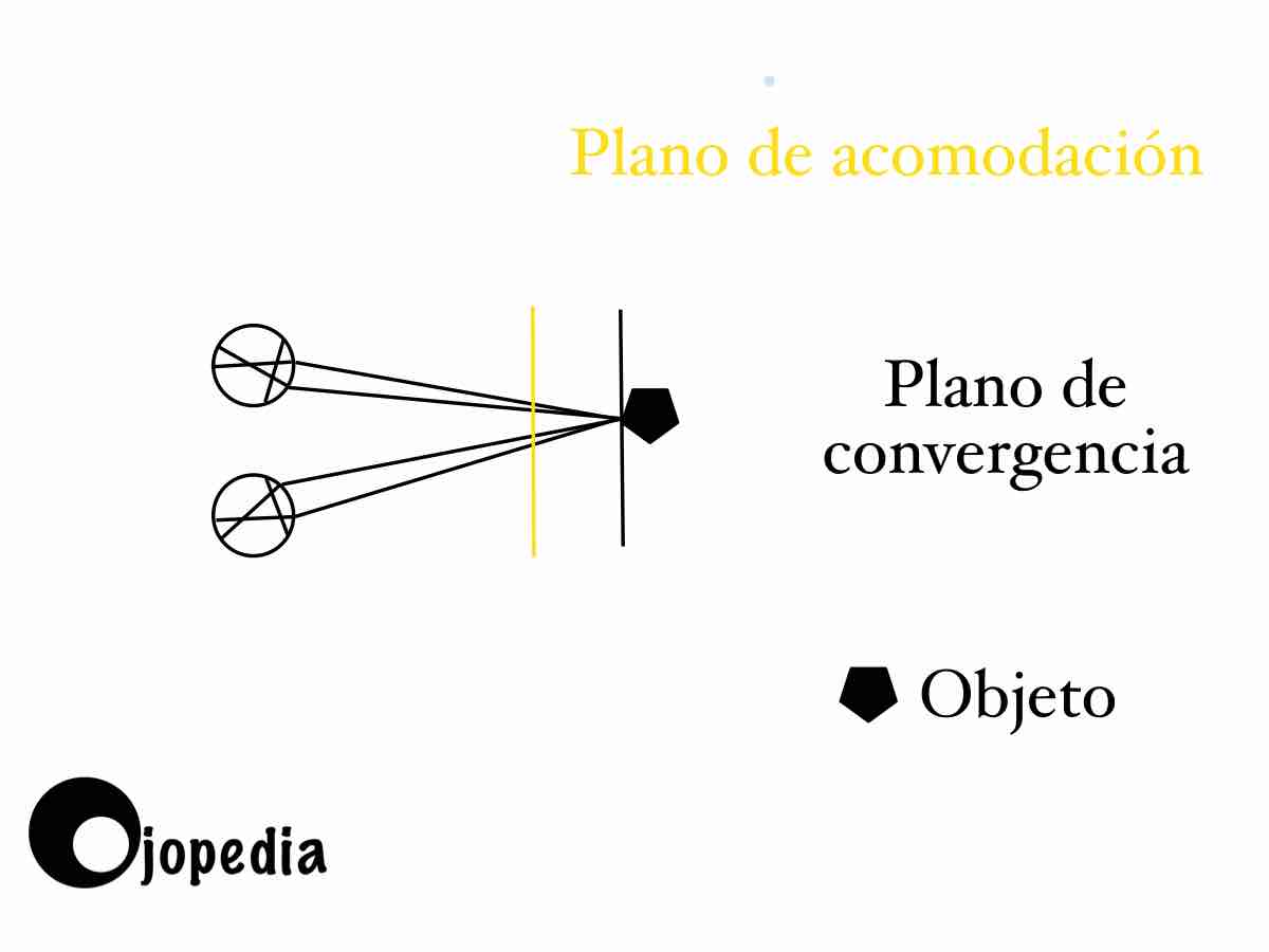 Exceso de acomodación - En Ojopedia