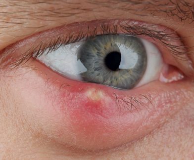Orzuelo en el ojo - En Ojopedia